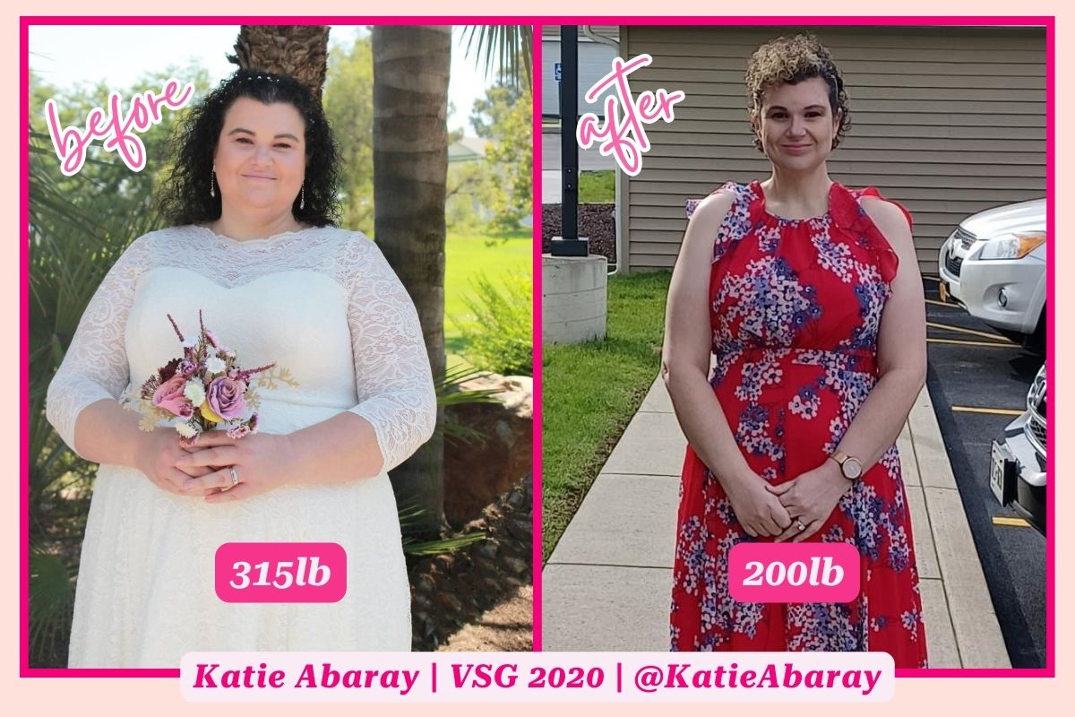 Gastric Sleeve Before and After (20+ Photos!) - The Sleeved Dietitian ...